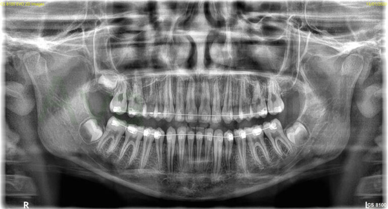 پانورکس دیجیتال کداک Kodak مدل CareStream OPG CS8100