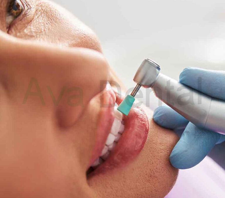 خمیر پالیش الماسه مروابن Diamond Mor-Polish | آوادنتال